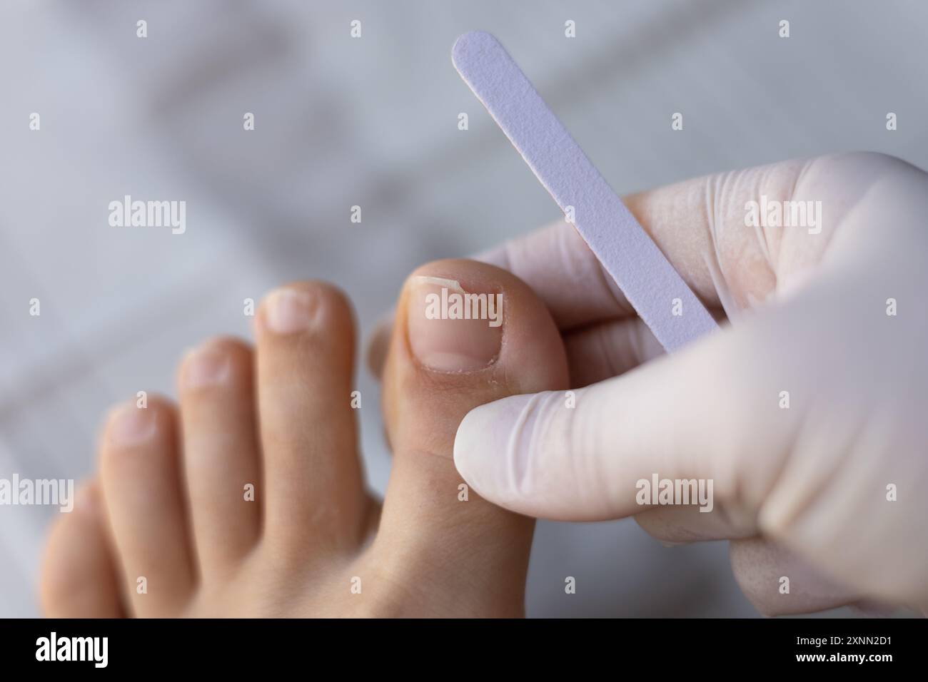 Close-up of broken and injured big toe nail Stock Photo - Alamy