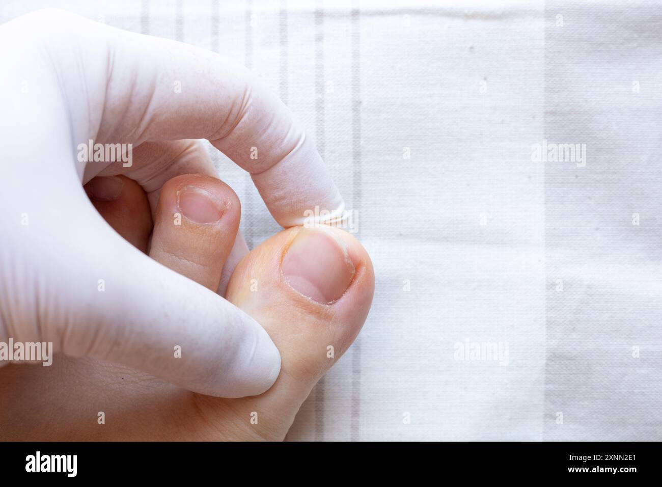 Close-up of broken and injured big toe nail Stock Photo - Alamy