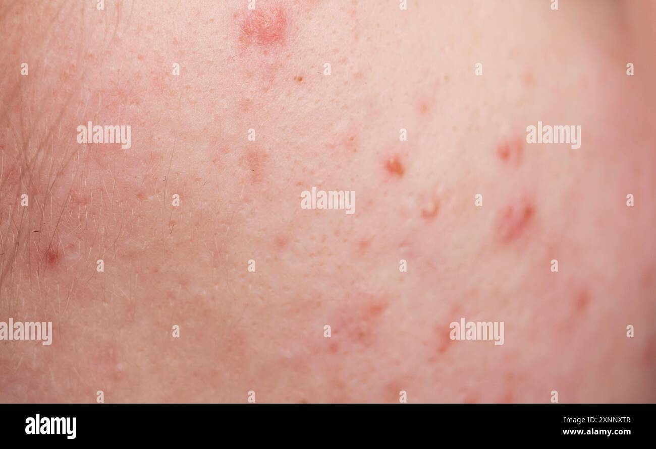 Pimple on face. Skin texture. Closeup acne skin. Treatment for skin ...