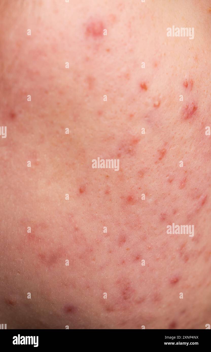 Skin texture background. Closeup acne pimple. Treatment for skin ...