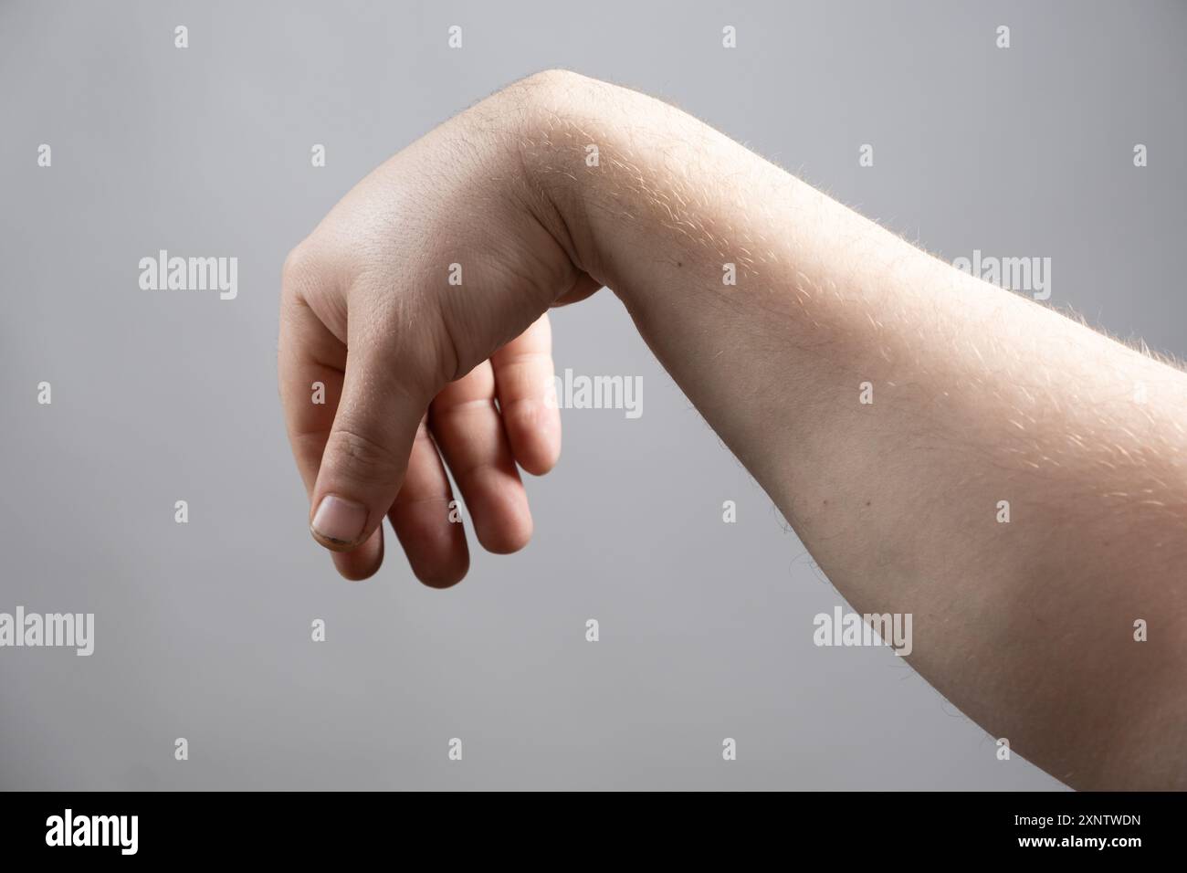 Ganglion cyst or hygroma of the wrist on the hand of a male patient ...