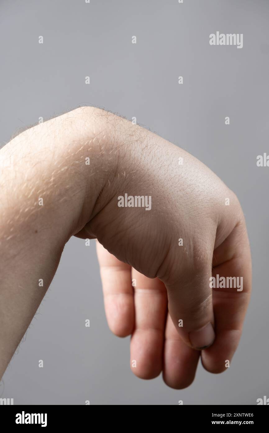 Ganglion cyst or hygroma of the wrist on the hand of a male patient ...