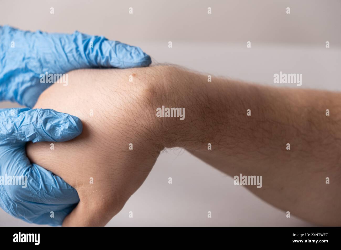 Ganglion cyst or hygroma of the wrist on the hand of a male patient ...