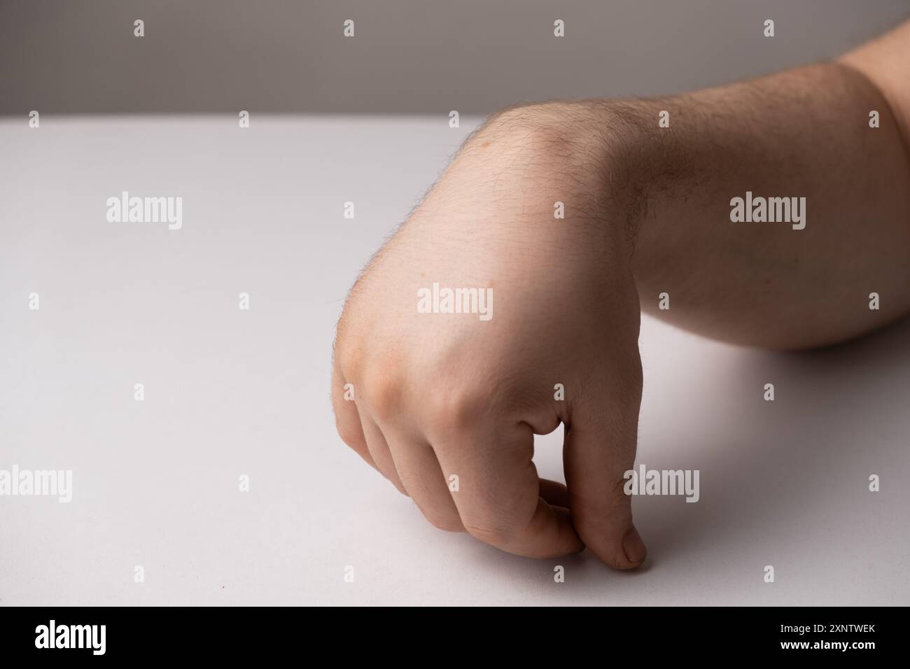 Ganglion cyst or hygroma of the wrist on the hand of a male patient ...