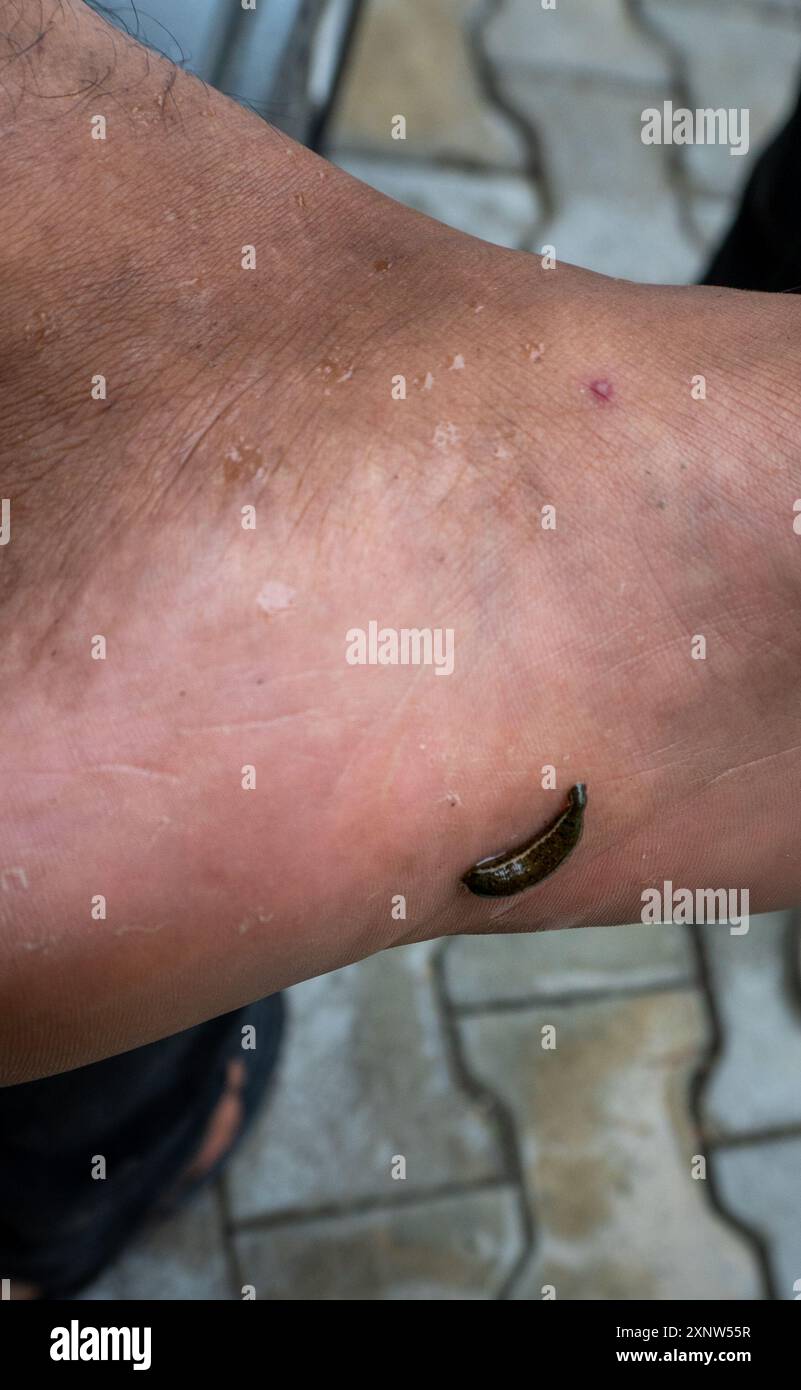 A leech attached to the foot of an Indian male in Uttarakhand, India ...