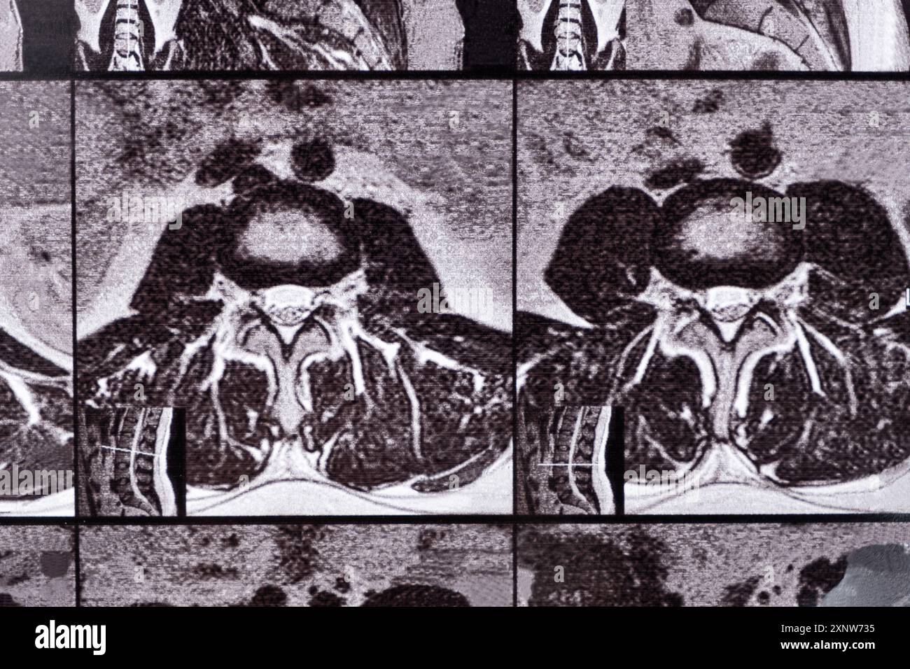 MRI of a patient with intervertebral disc protrusion and ...