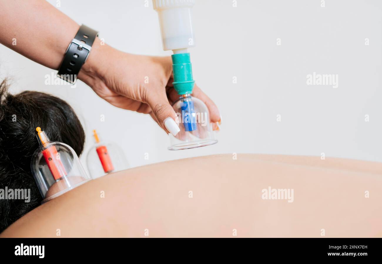 Professional hands placing therapeutic cupping. Physiotherapist placing ...
