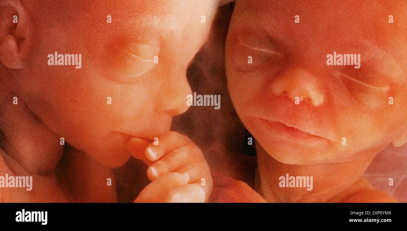 Foetus twins hi-res stock photography and images - Alamy