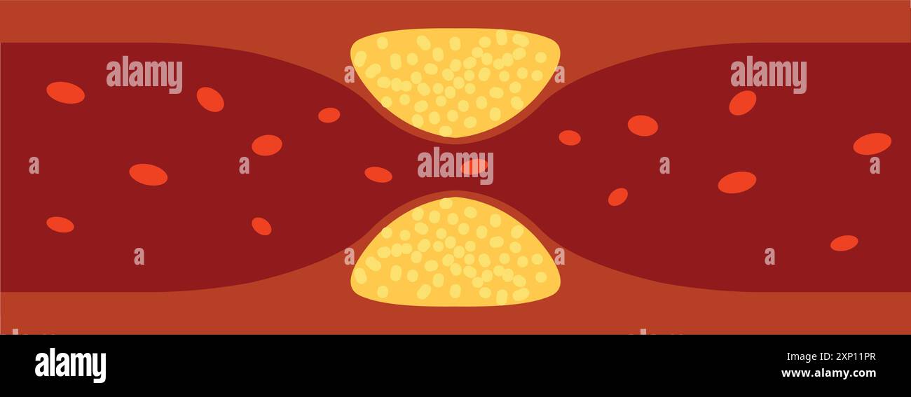 Icon cholesterol thrombosis artery microvascular disease ...