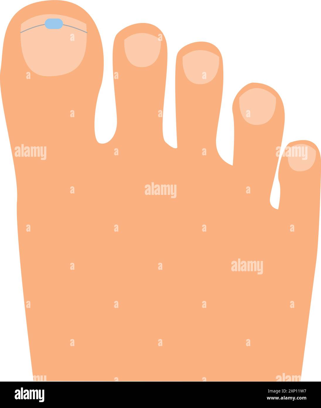 Toes on the right foot with a titanium staple on the thumb for ...