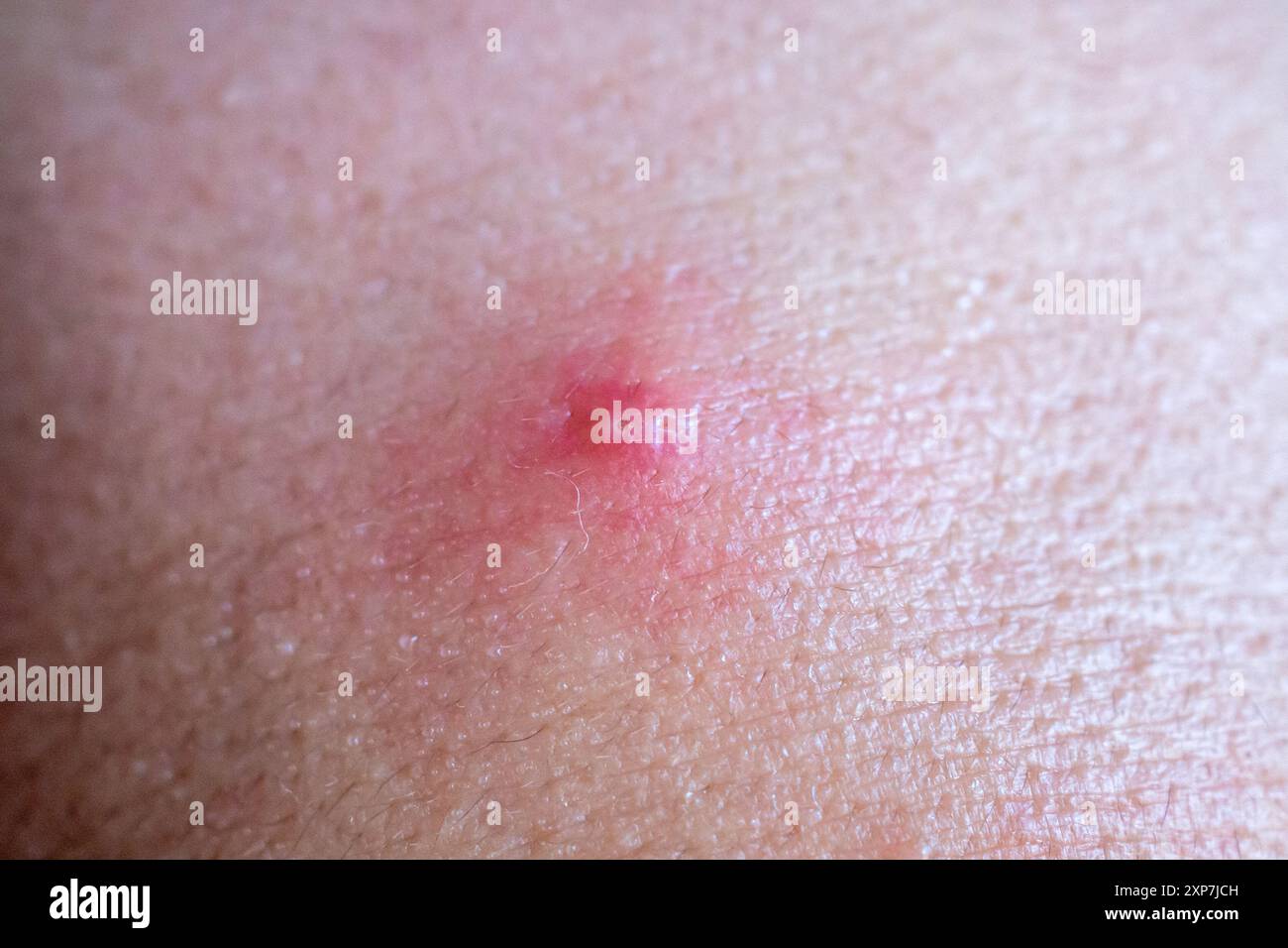 Inflammatory acne with red spot on face closeup Stock Photo - Alamy