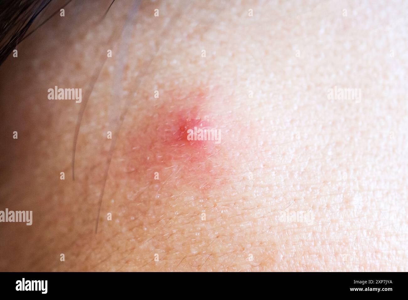 Inflammatory acne with red spot on face closeup Stock Photo - Alamy