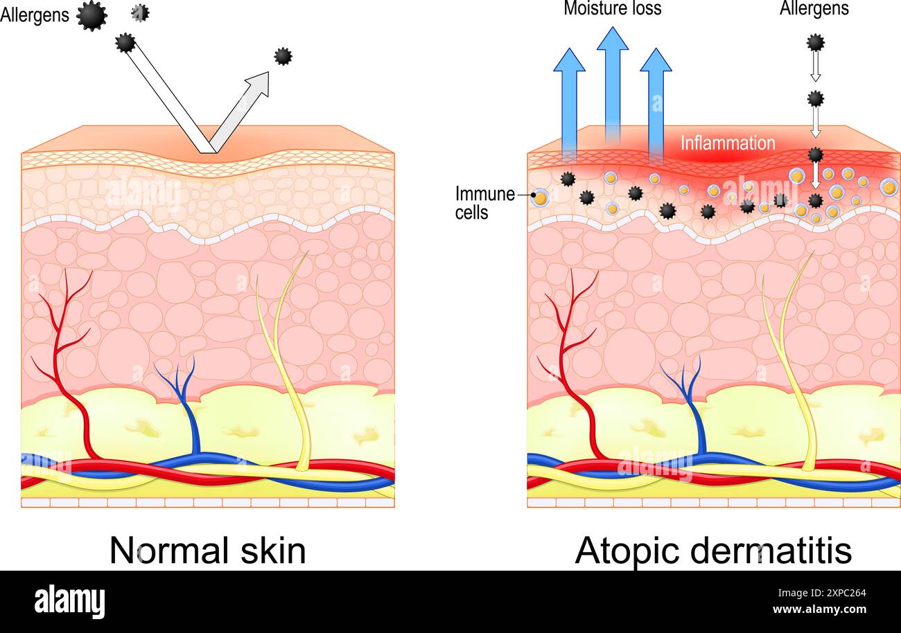 Atopic Dermatitis Eczema Cross Section Of Normal Skin And Dry Skin
