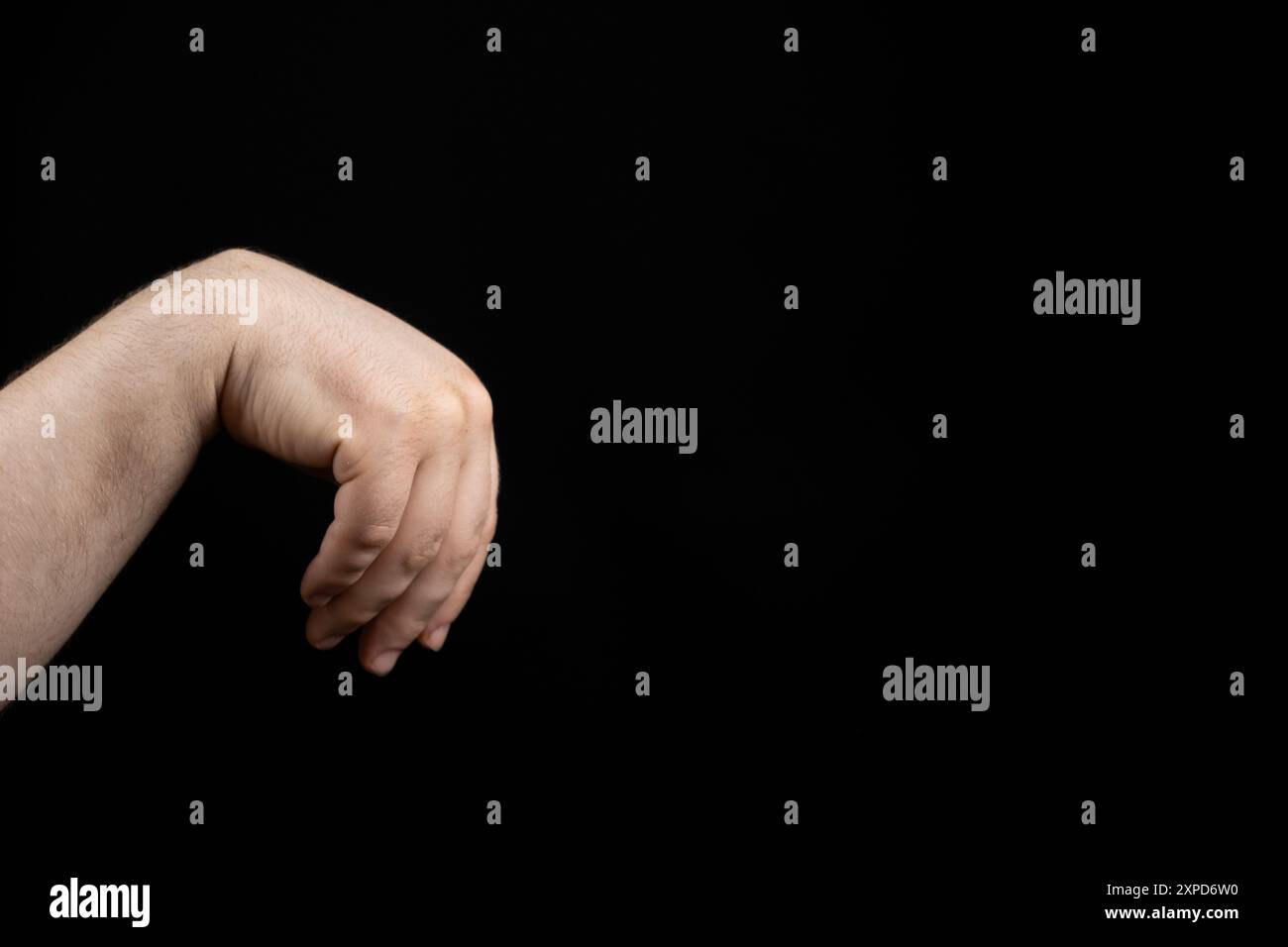 Ganglion cyst or hygroma of the wrist on the hand of a male patient ...