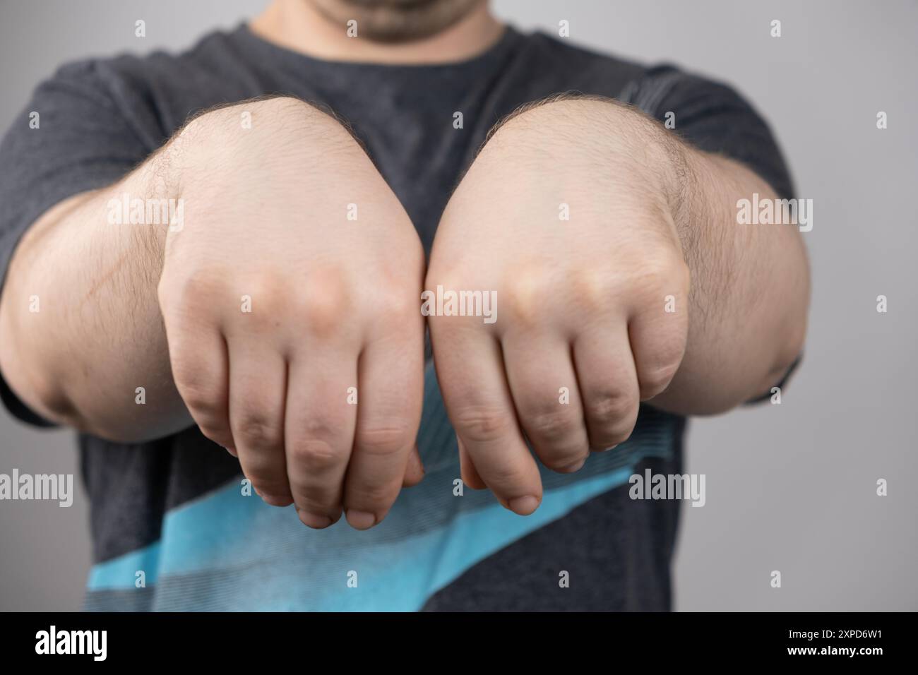 Comparison of healthy arm and arm with wrist ganglion cyst Stock Photo ...