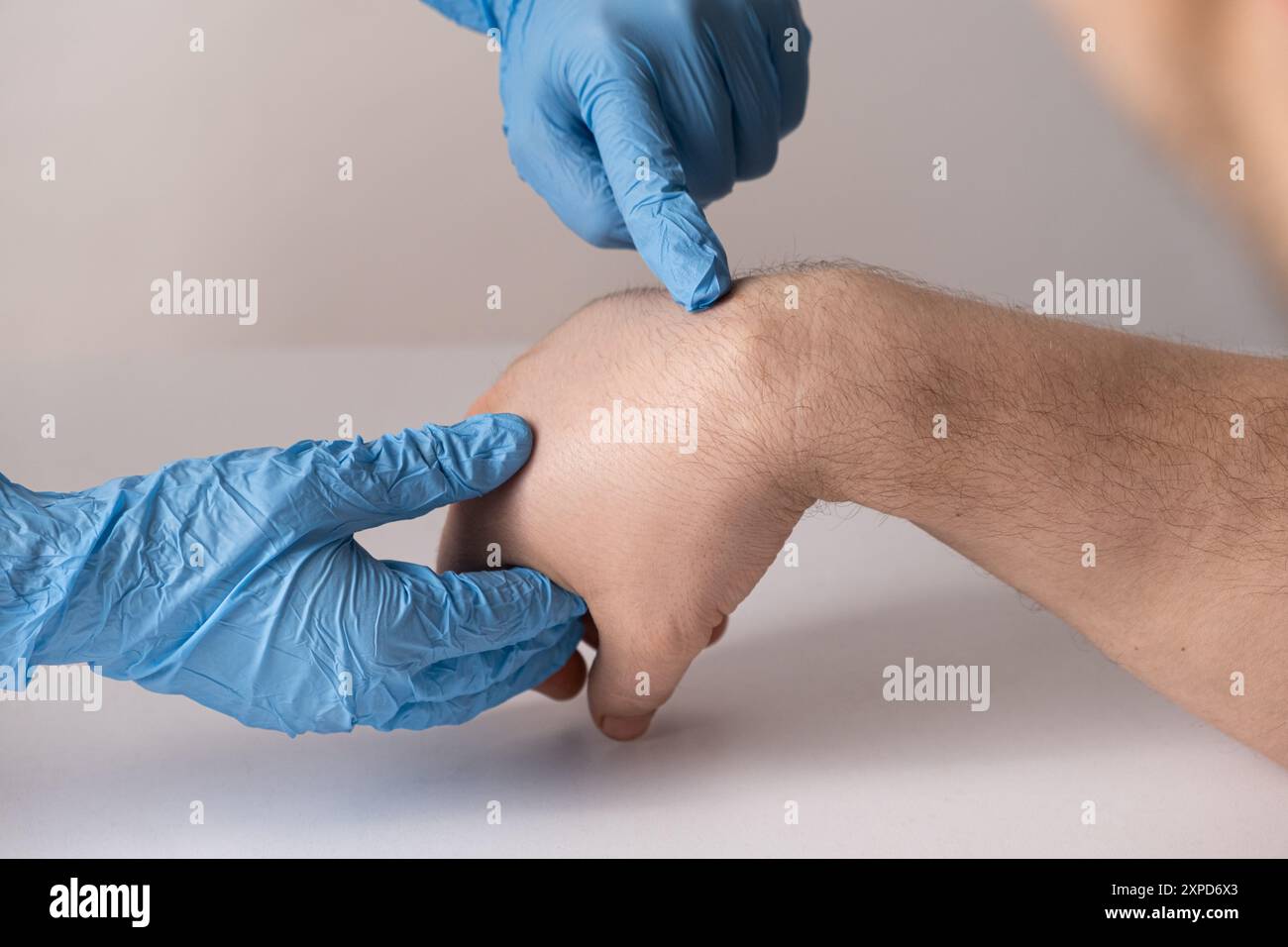 Ganglion cyst or hygroma of the wrist on the hand of a male patient ...