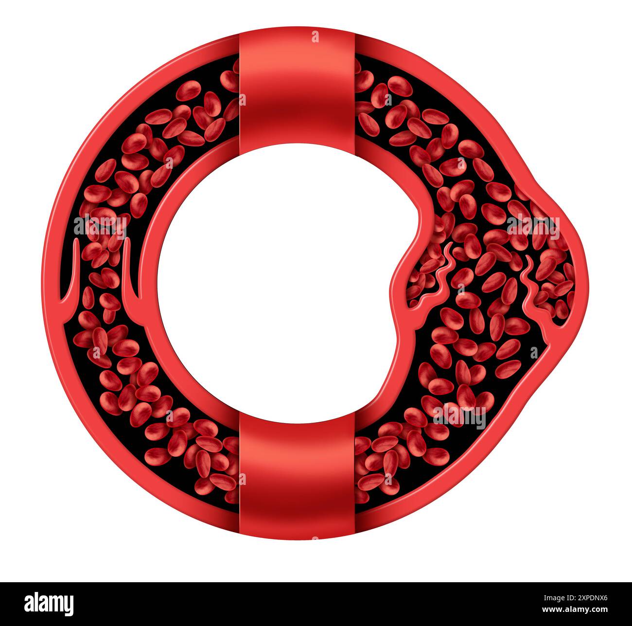 Venous Insufficiency Vein Disease as a damaged or weakened valve in ...