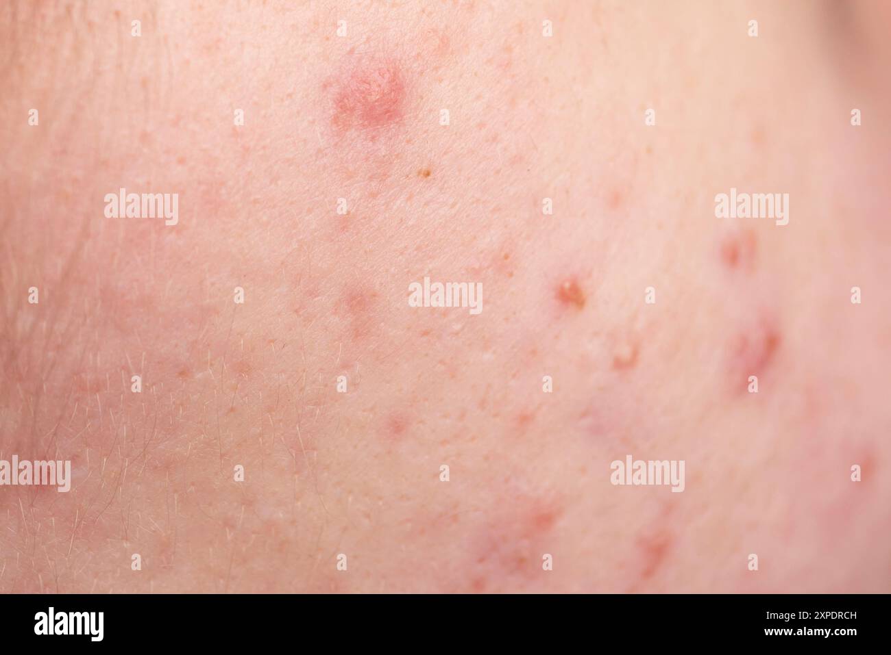 Pimple on face. Skin texture. Closeup acne skin. Treatment for skin ...