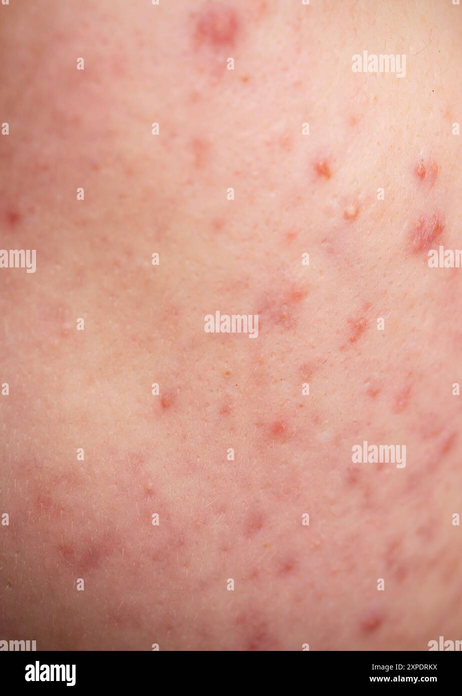 Skin texture background. Closeup acne pimple. Treatment for skin ...