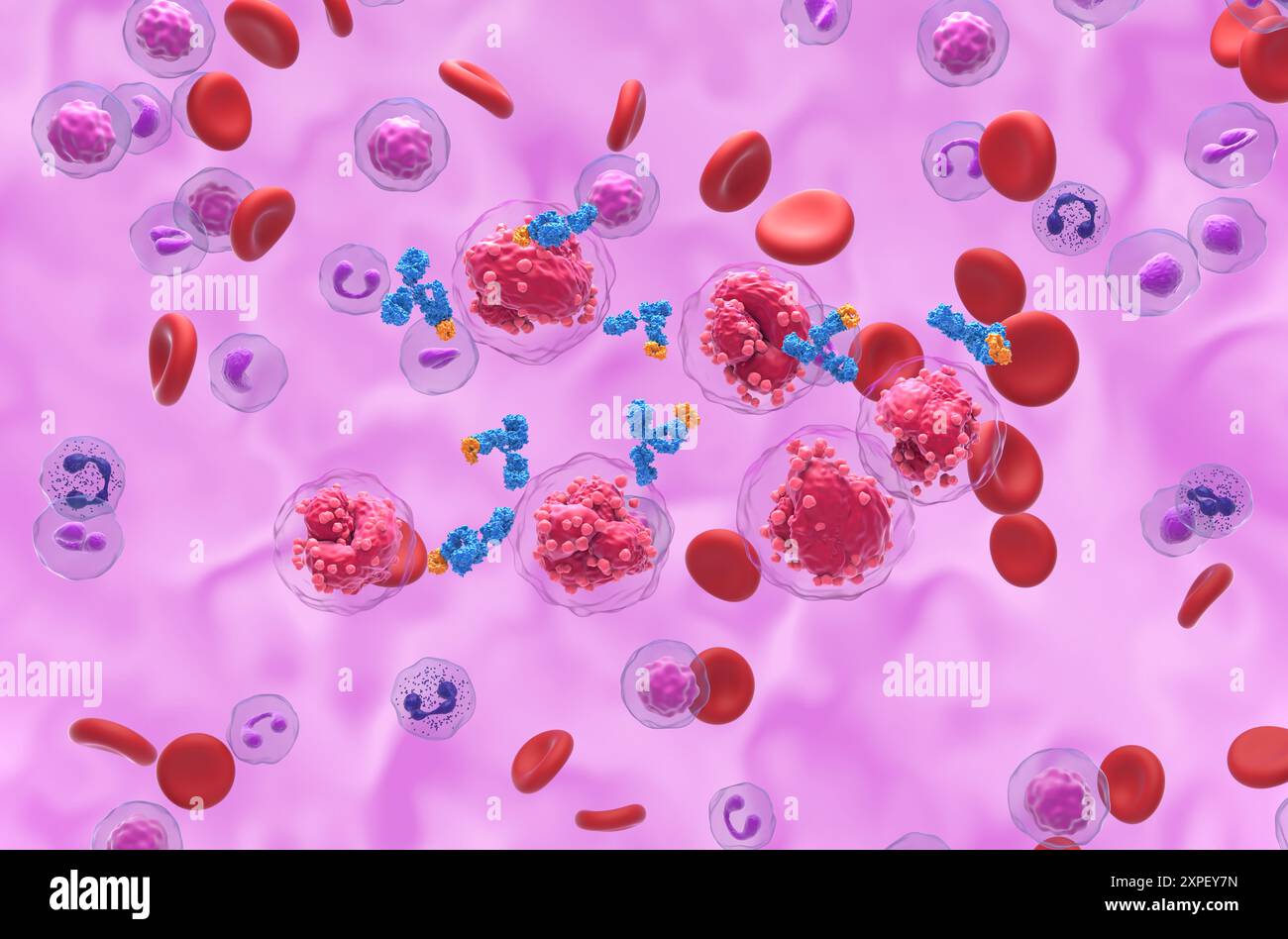 Monoclonal antibody therapy in Acute Lymphocytic Leukemia (ALL ...