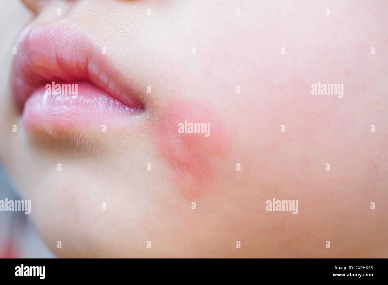 little asian girl skin rash and allergy with red spot cause by mosquito ...