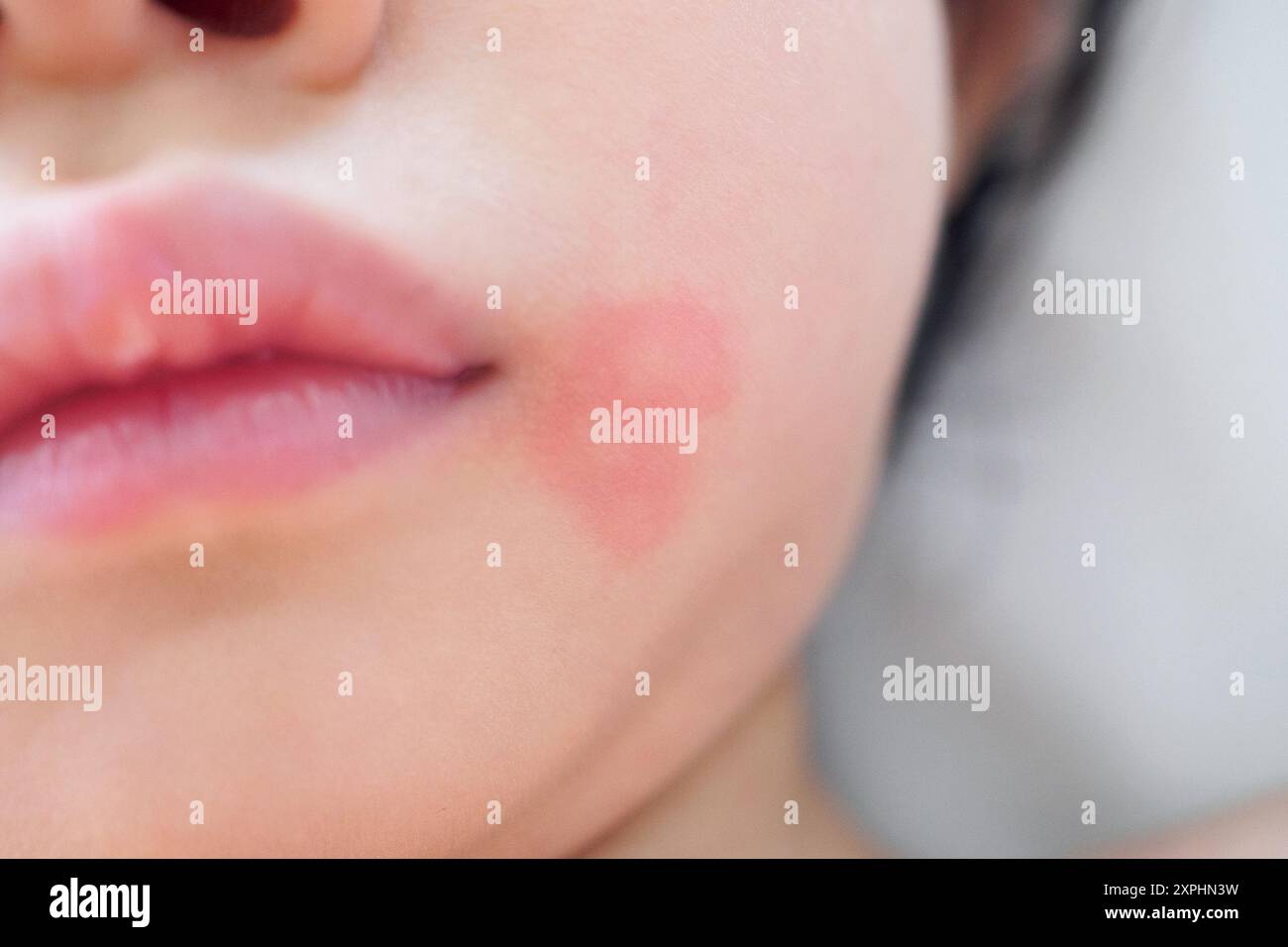 little asian girl skin rash and allergy with red spot cause by mosquito ...