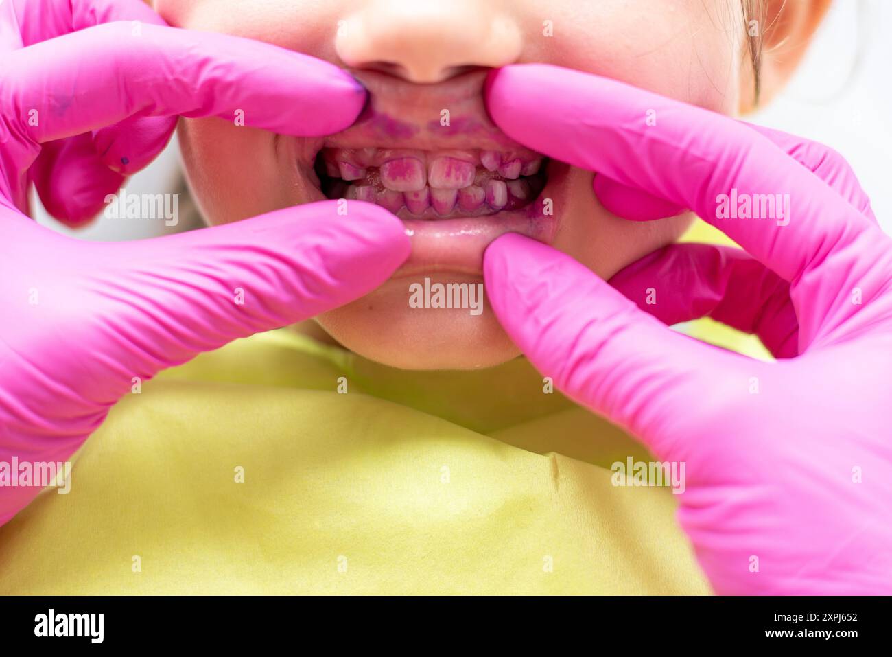 Dentist applying plaque disclosing solution to child's teeth Stock ...