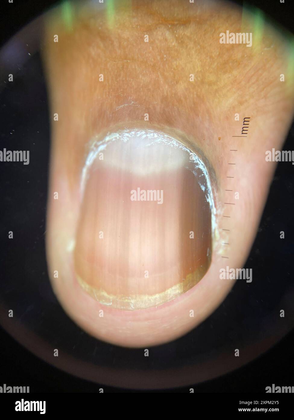 Dermatoscope image of the nail of a 34 year old African American female ...