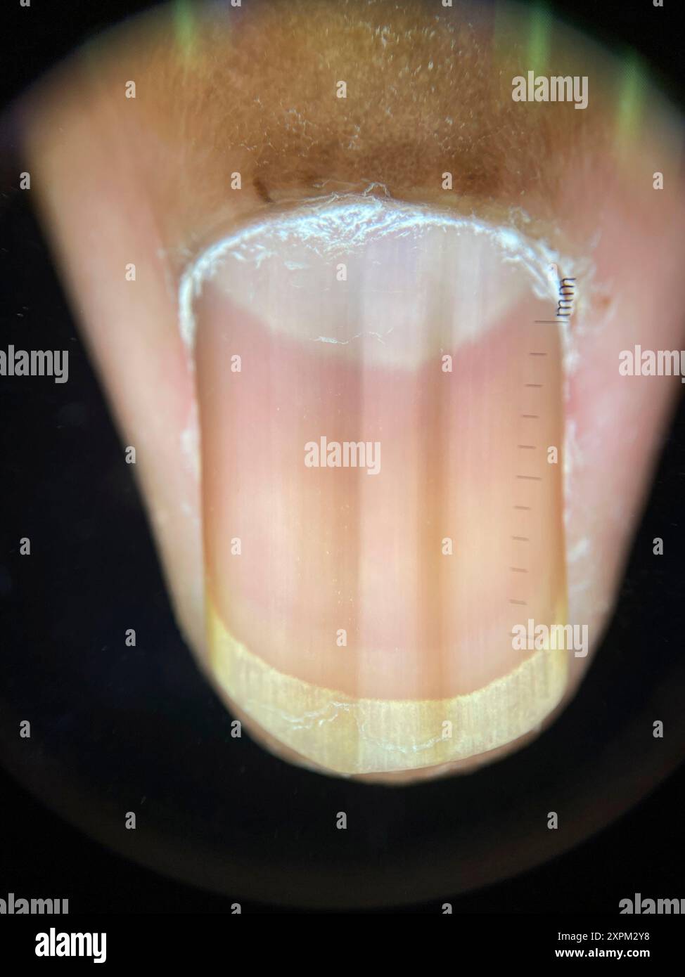 Dermatoscope image of the nail of a 34 year old African American female ...