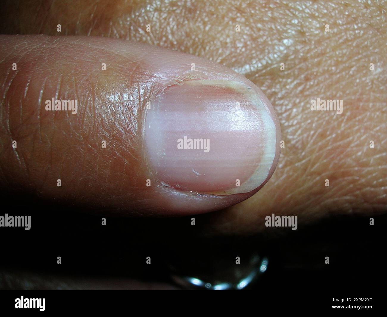 Nail of a patient with longitudinal (lengthwise) melanonychia ...
