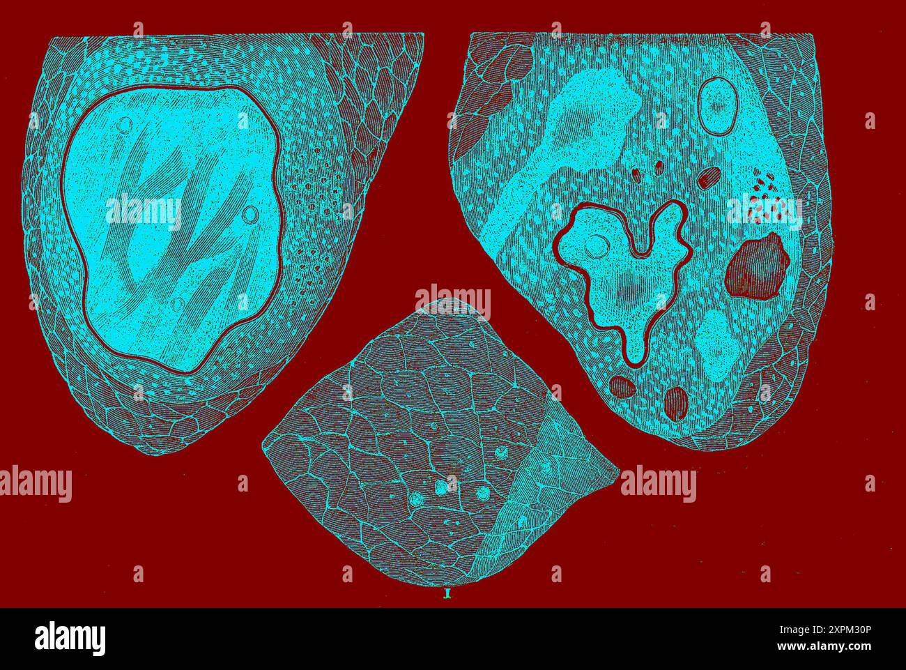 Illustrations of sections through lung tissue with tuberculosis (TB ...