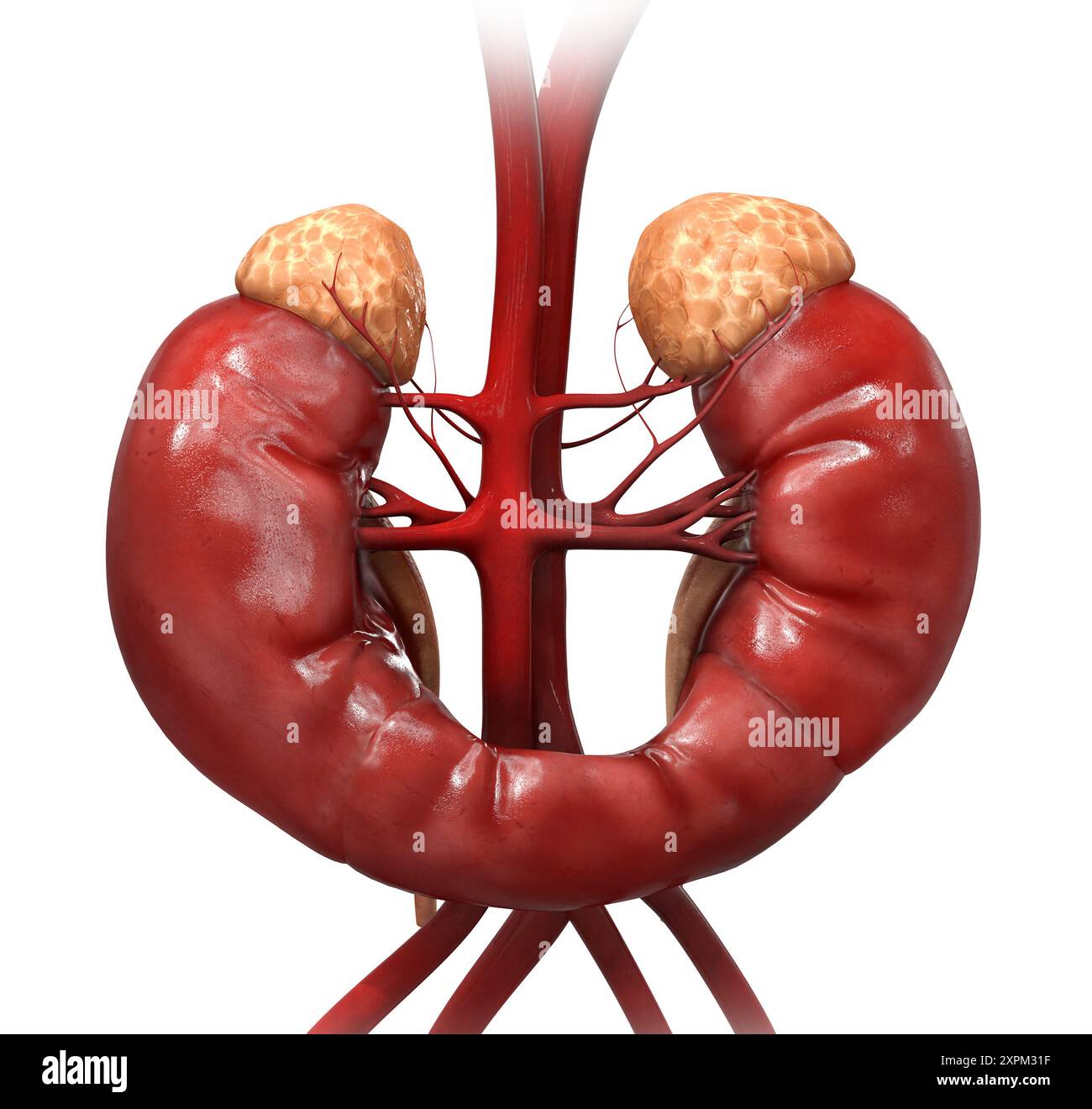 Illustration of a horseshoe kidney. This is a congenital abnormality ...