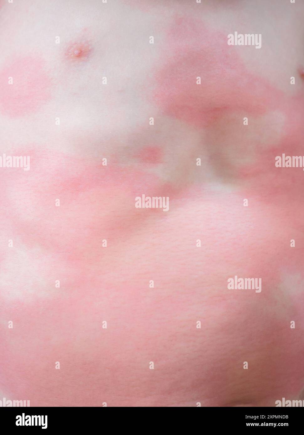 Severe eczema skin rash and allergic reaction symtom at little asian ...