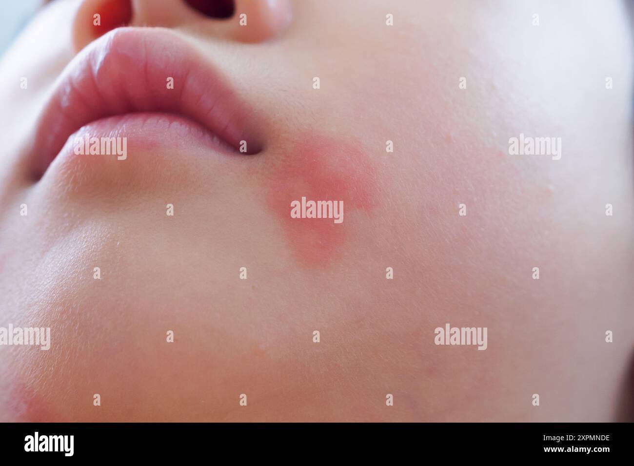 little asian girl skin rash and allergy with red spot cause by mosquito ...