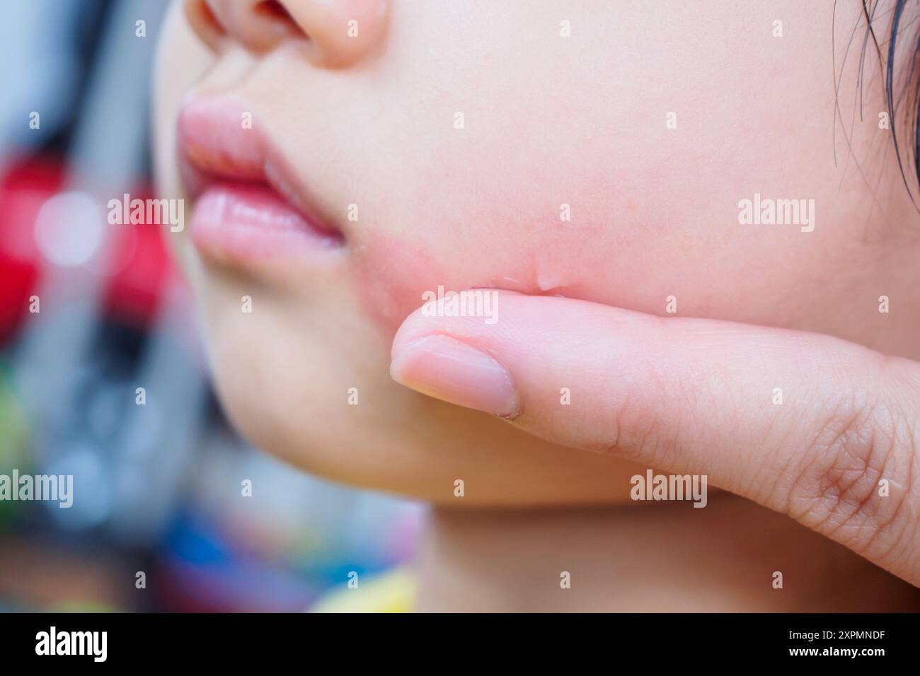 Dermatitis eczema face rash hi-res stock photography and images - Alamy