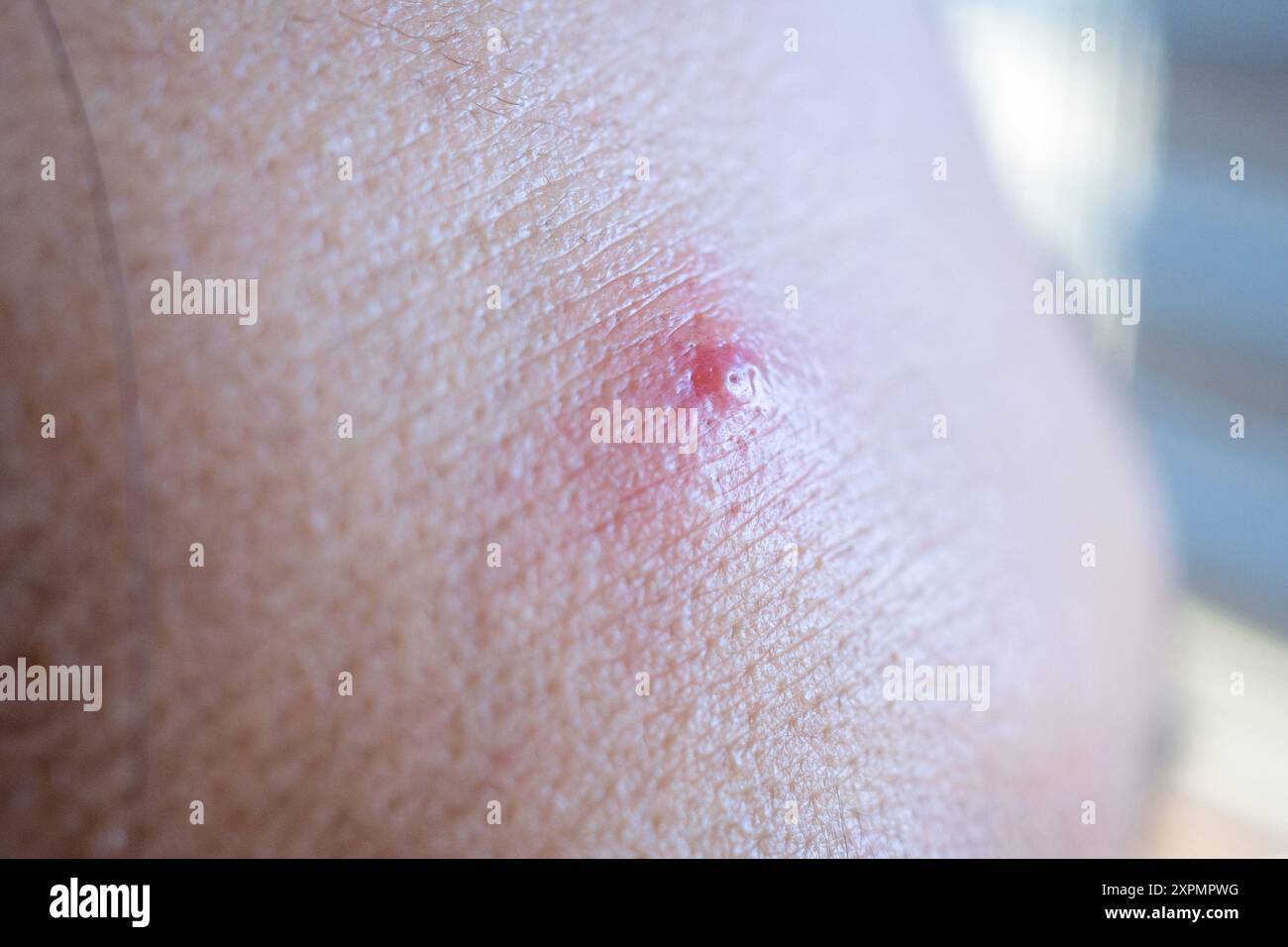 Cystic acne on face hi-res stock photography and images - Alamy