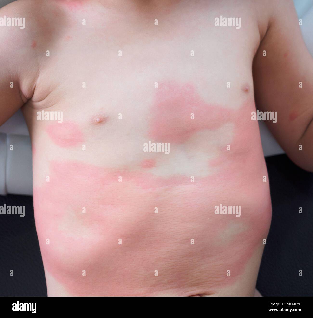 Severe eczema skin rash and allergic reaction symtom at little asian ...