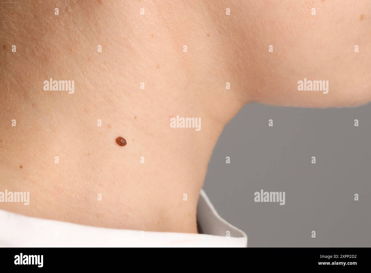 Woman with mole on her skin against grey background, closeup Stock ...