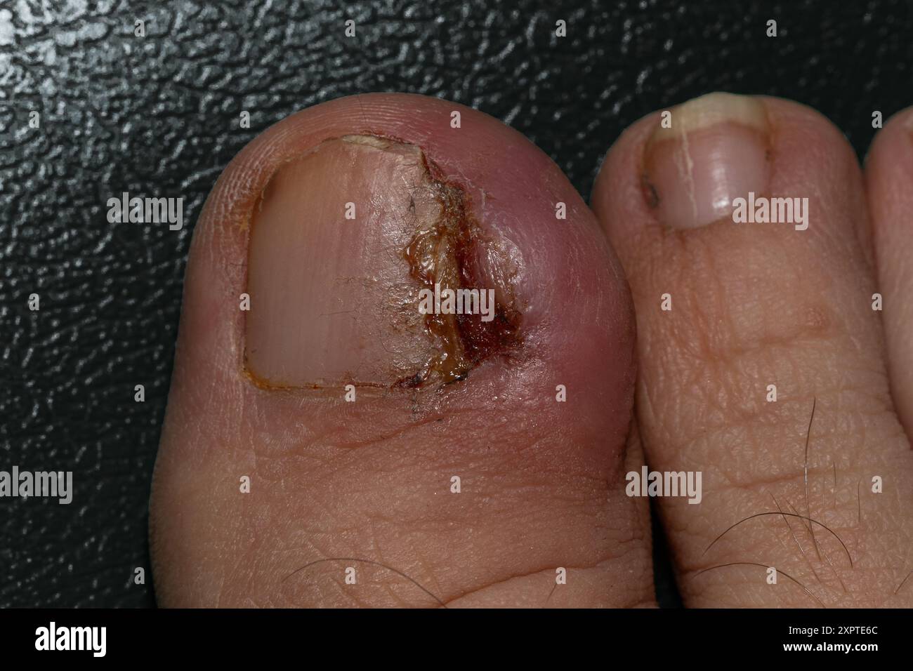 Close-up of an infected toenail showing signs of inflammation and urgent care needed Stock Photo ...