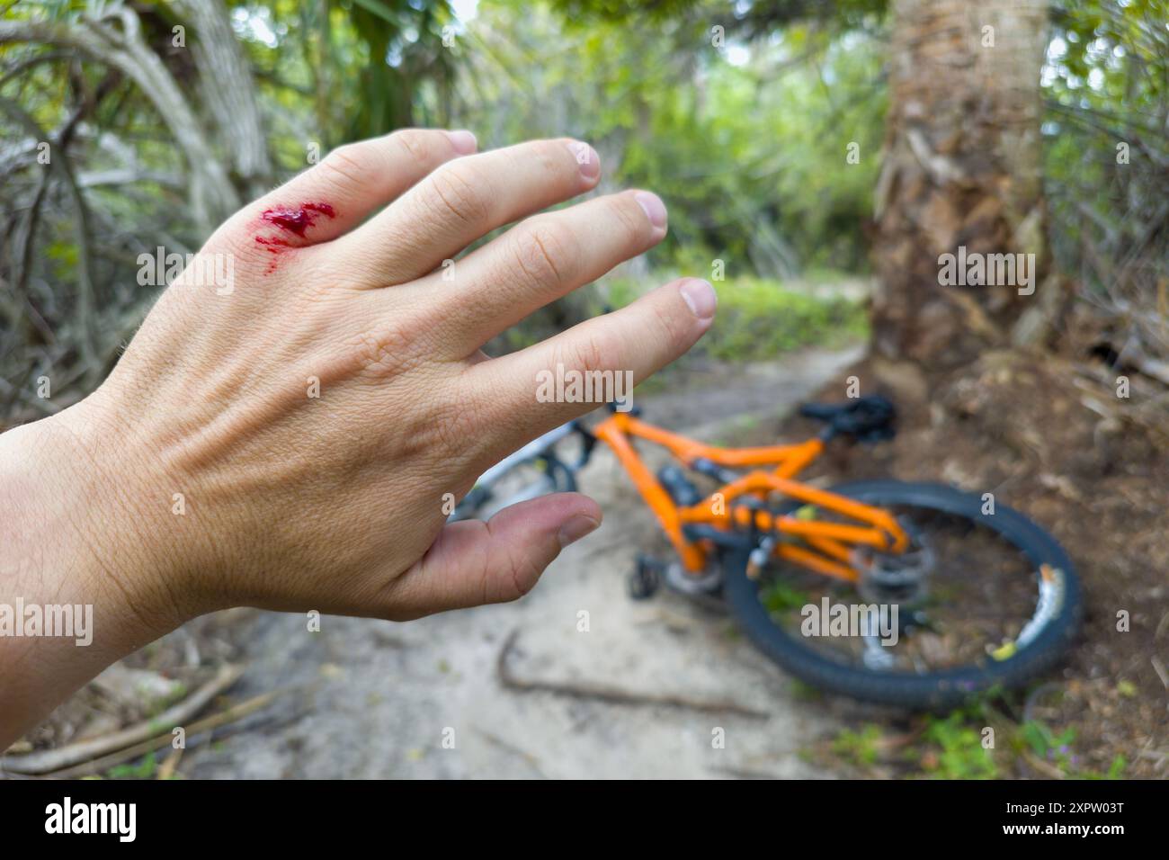 Bike rider hand injury with red blood from hitting a tree stump ...