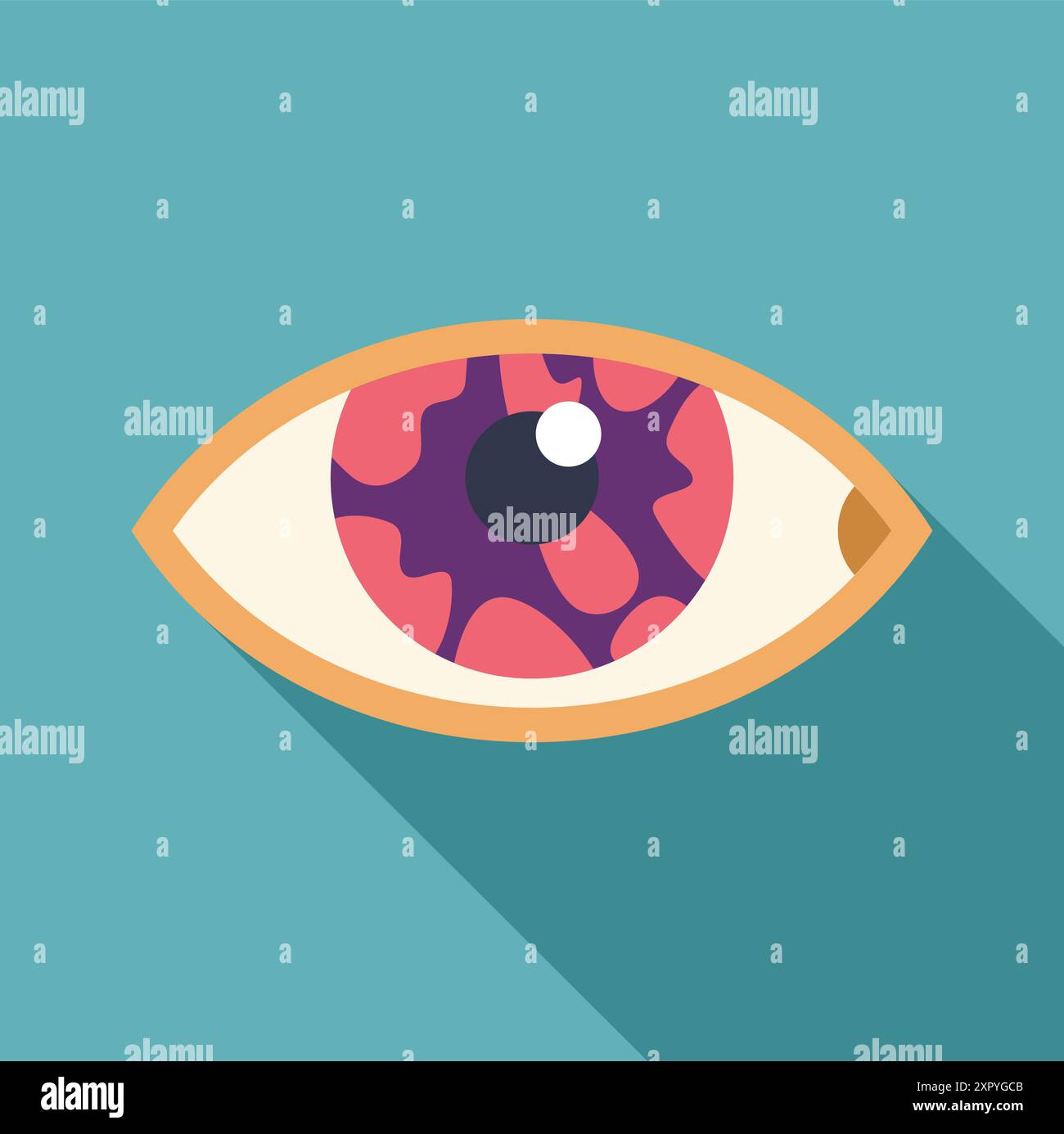 Illustration of a bloodshot eye, showing symptoms of disease such as ...