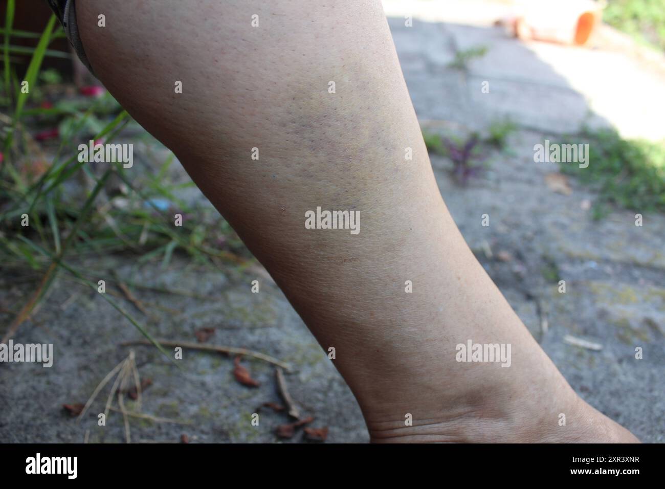 Bruise on the leg side angle. Skin lesions on the leg Stock Photo - Alamy