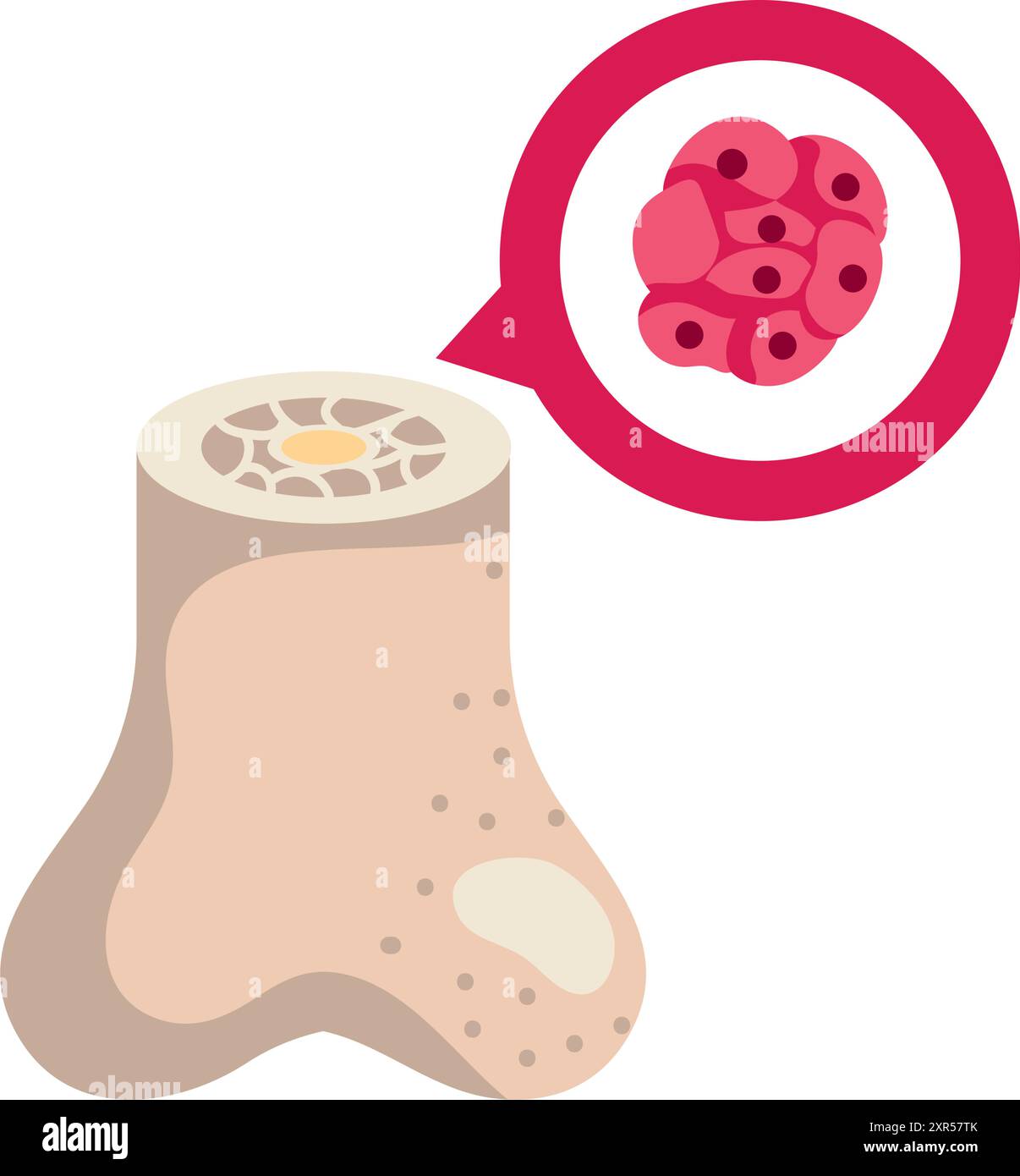 multiple myeloma bone awareness Stock Vector Image & Art - Alamy