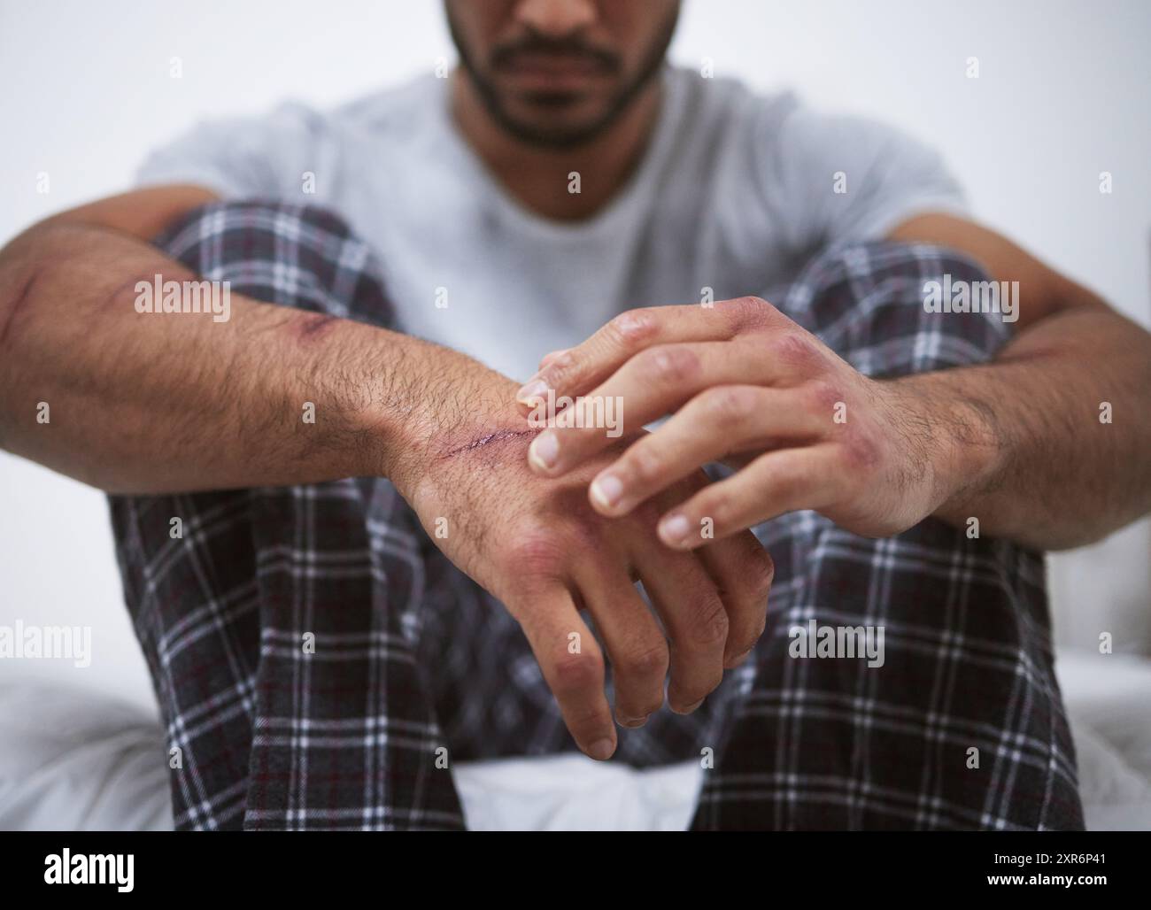 Man, sad and hand scratch for depression, anxiety and trauma as patient ...