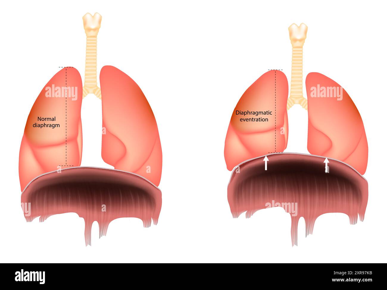 Normal diaphragm or Diaphragmatic eventration. Abnormal elevation of a ...