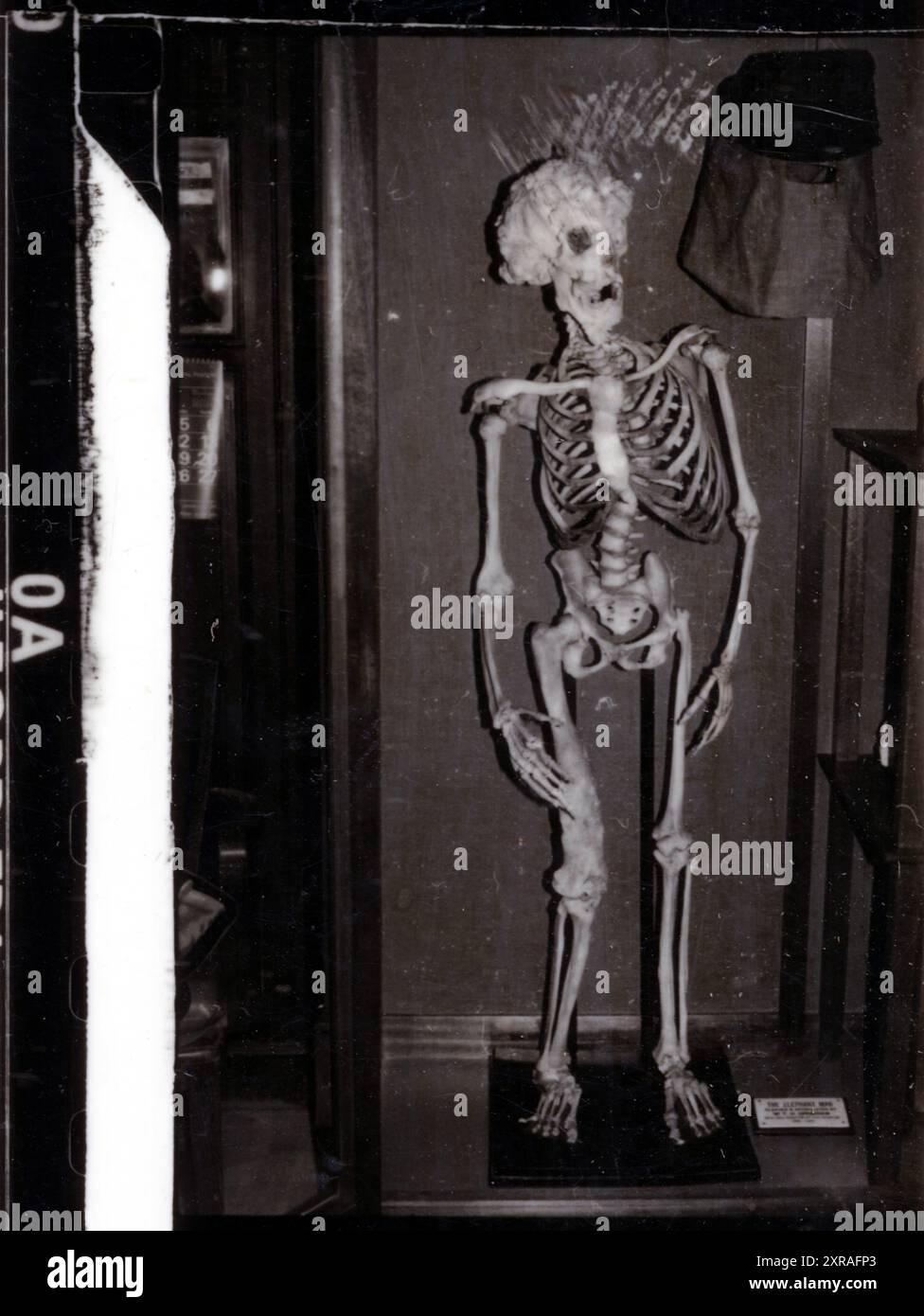 Joseph 'John' Carey Merrick (1862-90) - aka The Elephant Man. Pathology ...