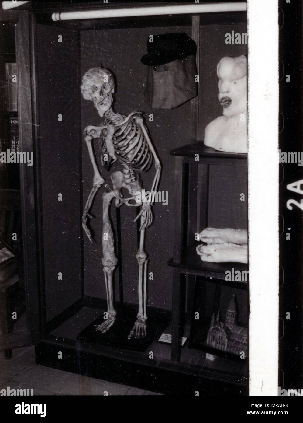 Joseph 'John' Carey Merrick (1862-90) - aka The Elephant Man. Pathology ...
