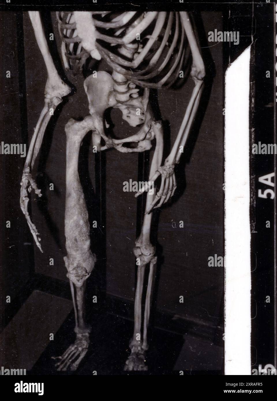 Joseph 'John' Carey Merrick (1862-90) - aka The Elephant Man. Pathology ...