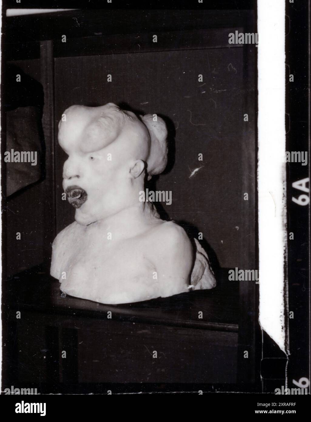 Joseph 'John' Carey Merrick (1862-90) - aka The Elephant Man. Pathology ...