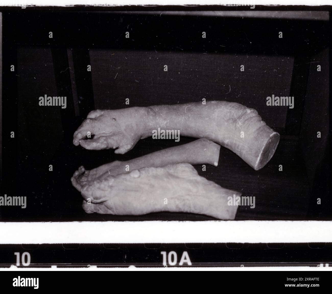 Joseph 'John' Carey Merrick (1862-90) - aka The Elephant Man. Pathology ...